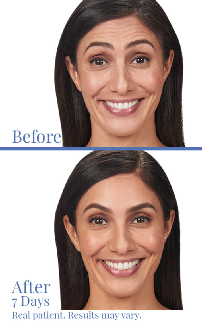 botox-lakewood-forehead-lines-before-after - Rocky Mountain Laser College